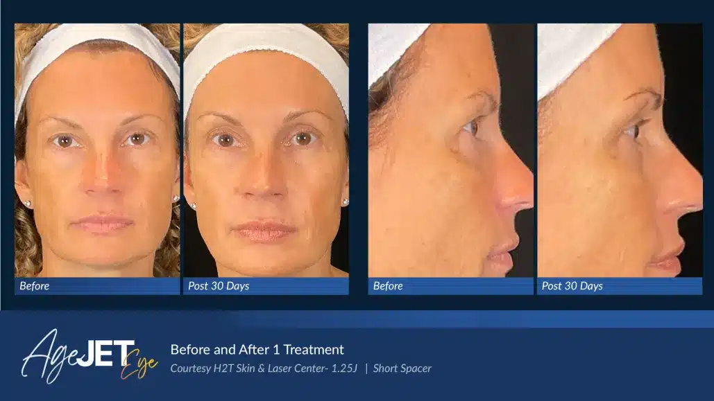 FAQ Guide for AgeJet Plasma Skin Rejuvenation | House of Skincare