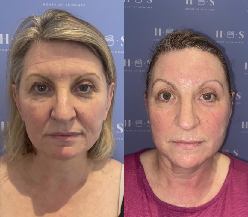 Exilis Ultra 360 Treatment | House Of Skincare | Skin Tightening